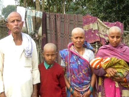 हैंडपंप के पानी से नहाने के बाद पूरा परिवार हो गया गंजा