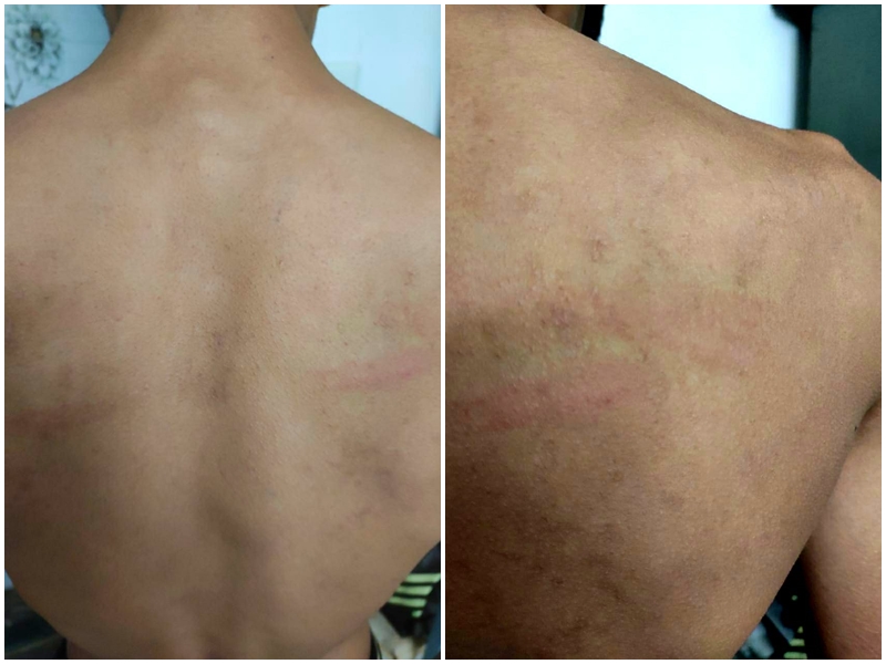 जबलपुर के मॉडल स्‍कूल में शिक्षक ने छात्रों की डंडे से पिटाई की, पीठ पर ...