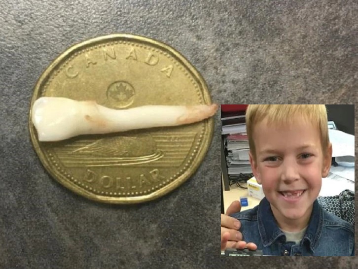 Guinness World Record: इस बच्चे का दूध का दांत सबसे लंबा, बन गया विश्व ...