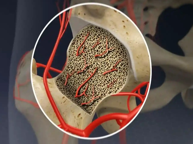 Bone Death: कोरोना संकट के बीच अब ‘बोन डेथ’ का खतरा, जानें क्या है ये ...