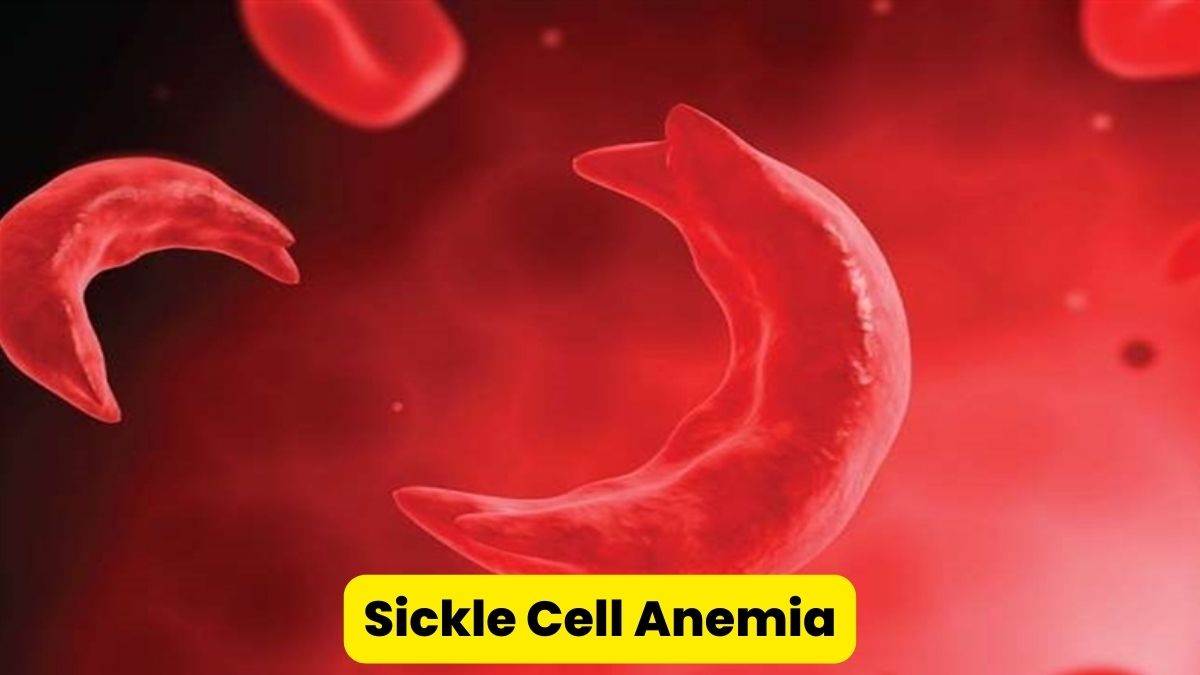 Sickle Cell Anemia: सिकल सेल से लड़ने में हथियार बनेगी होम्योपैथी ...