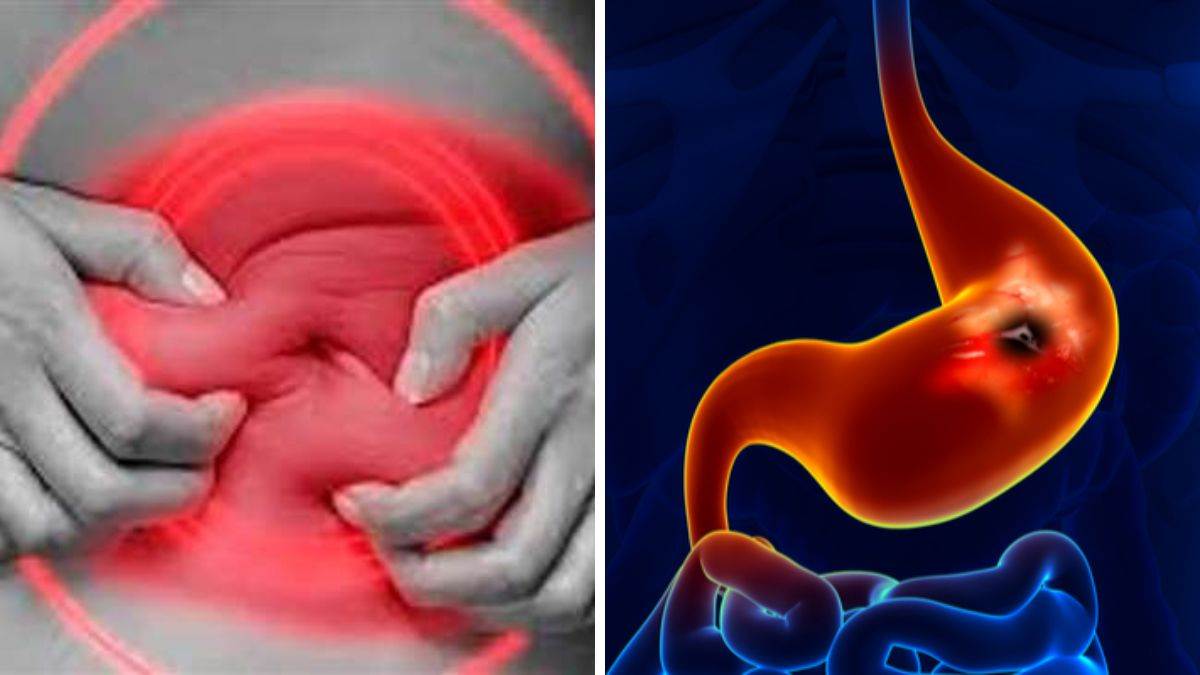 Health Tips: अक्सर होती है पेट में जलन? अल्सर के हो सकते हैं लक्षण ...