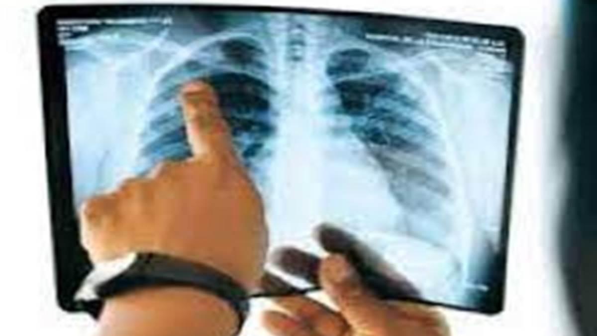 World Tuberculosis Day 2024: मप्र में 1.90 लाख टीबी मरीज खोजने का लक्ष्य, अब तक खोजे महज 20 ...