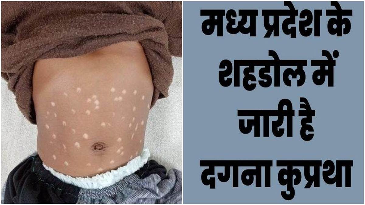 Dagna In Shahdol : शहडोल में फिर इलाज के नाम पर दो माह के मासूम को गर्म ...