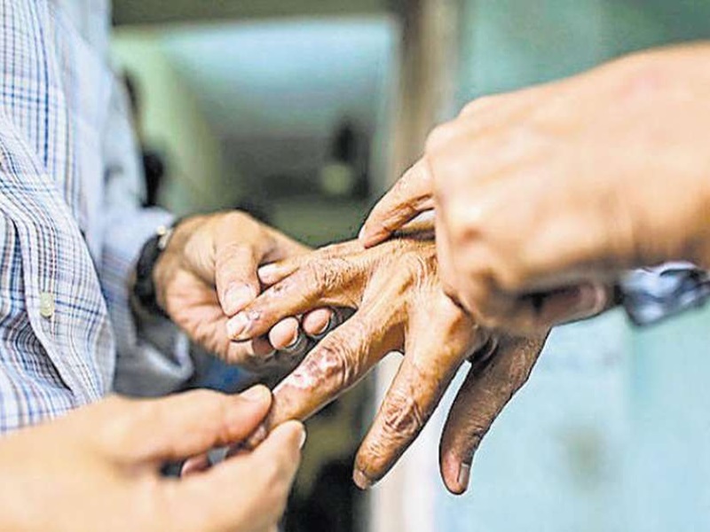 Panchayat Election 2020: क्या आपने कभी सोचा, कुष्ठ रोगी मतदान करें तो ...