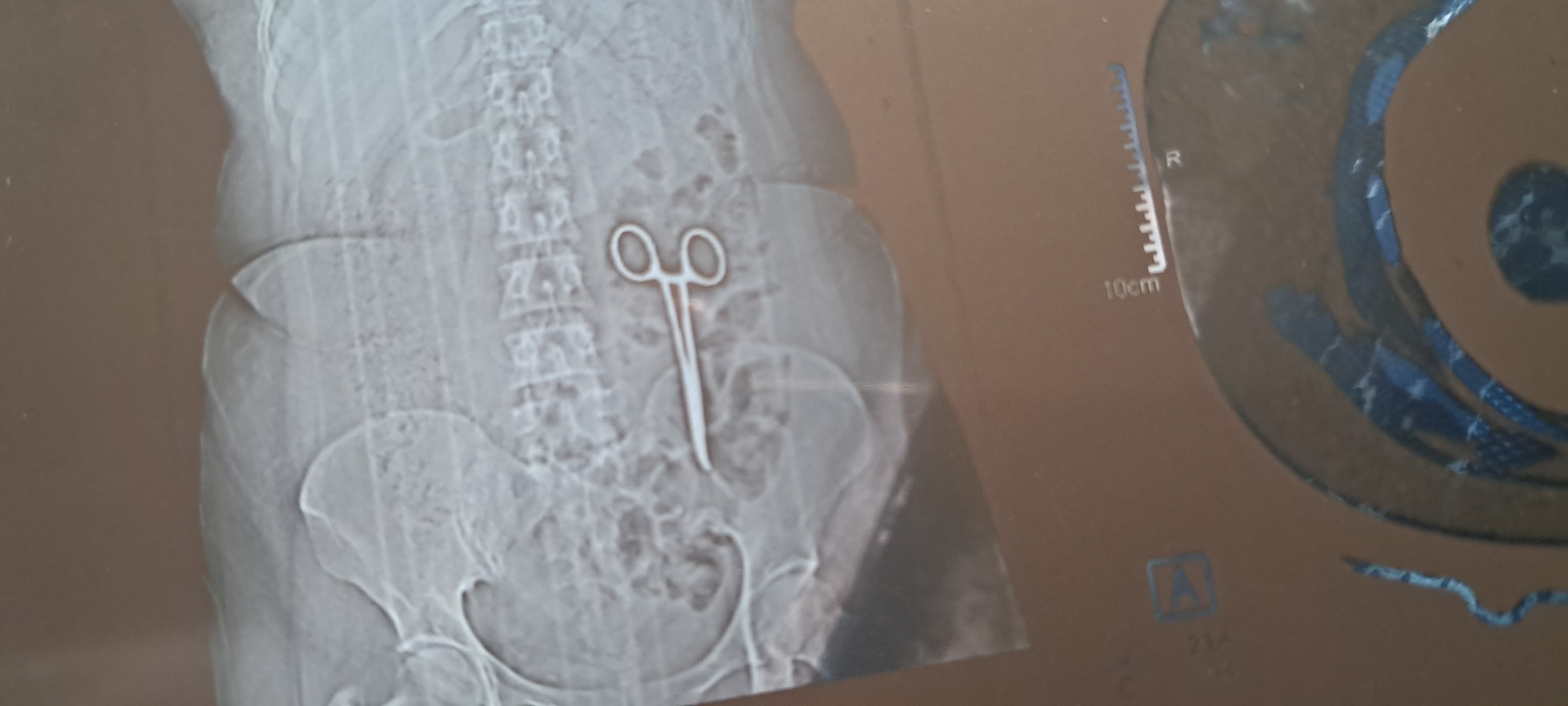 महिला के पेट में निकली कैंची; दर्द होने पर कराया CT Scan तो रह गए दंग ...