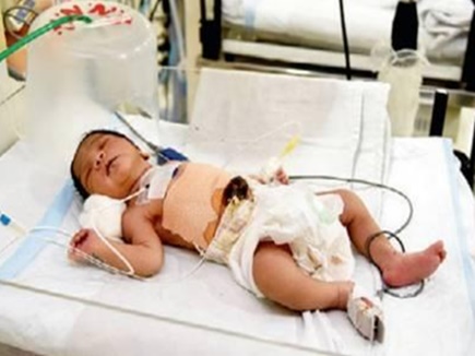 चार हाथ, चार पैर वाले बच्चे ने लिया जन्म, ऑपरेशन के बाद हुआ सामान्य