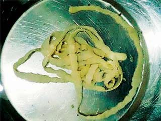 आश्चर्यजनकः इंसान की आंत से निकला चार मीटर लंबा जिंदा टेपवॉर्म