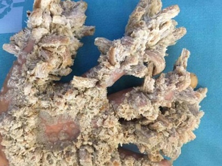 हाथ पर हुआ पेड़ की छाल जैसा घाव, दस साल रहा दुनिया से दूर