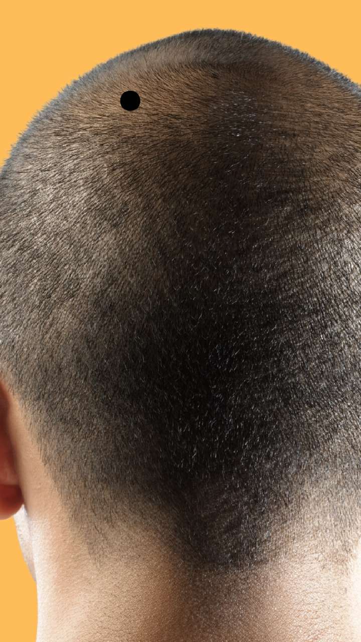 सिर पर तिल होने का मतलब? जानें इसके राज | what does mole on head say ...