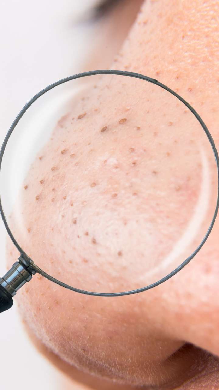 Blackheads होने पर एलोवेरा कैसे लगाएं?